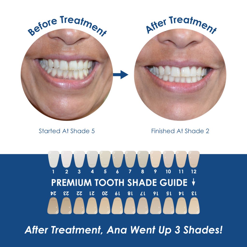 Mini Customized Dental Whitening Pens | Whiter Image