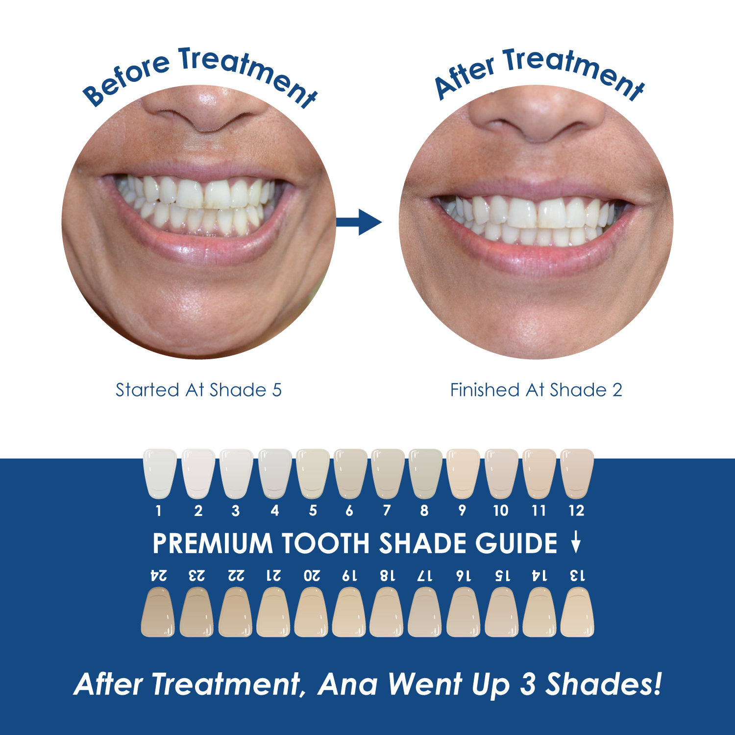 Mini Customized Dental Whitening Pens | Whiter Image